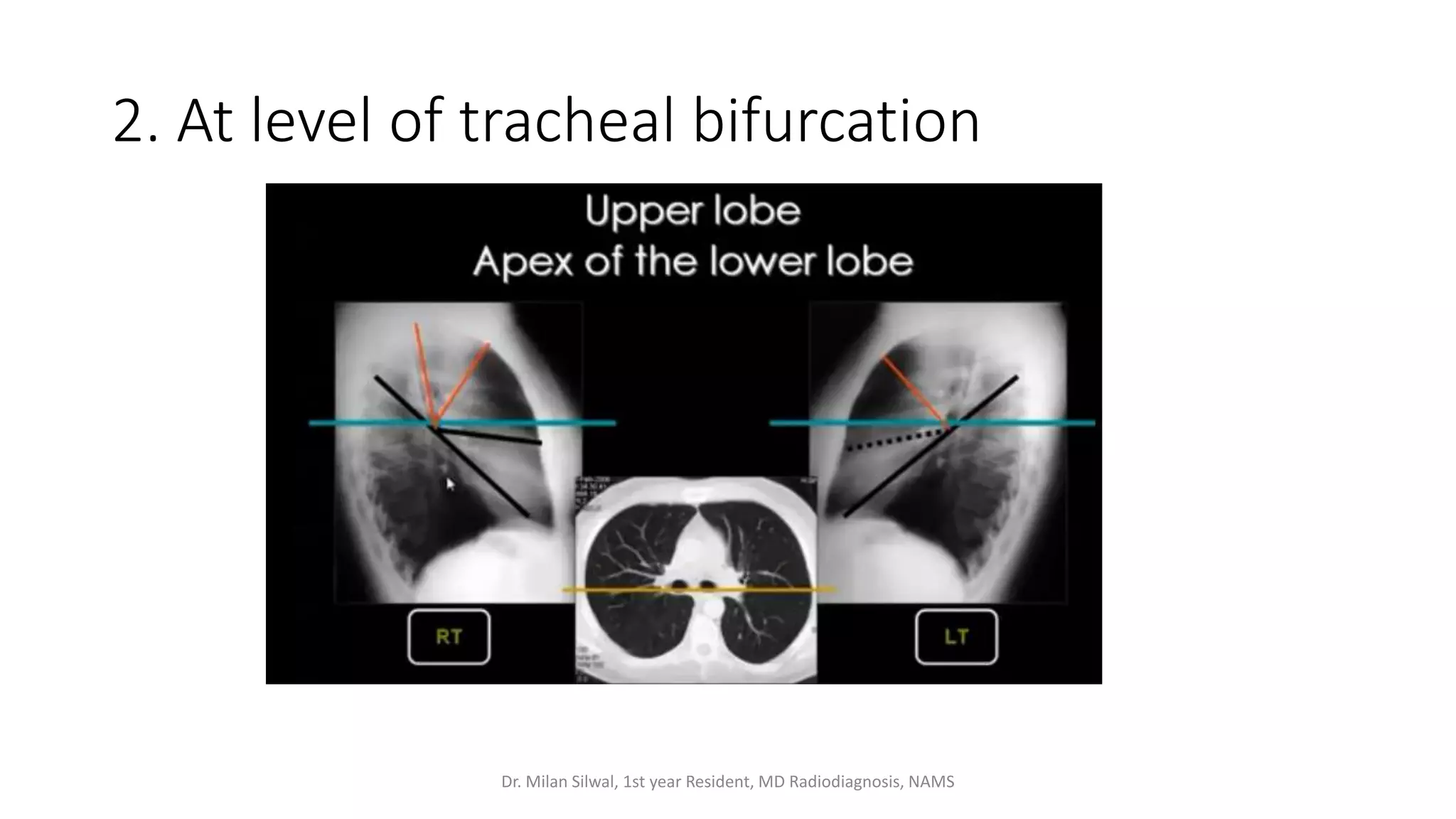 Cross sectional anatomy of chest by Dr. Milan | PPTX