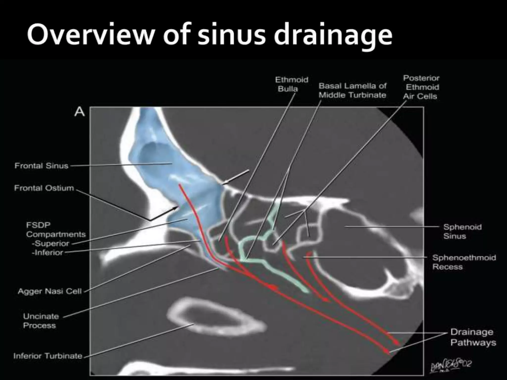 Cross Sectional Anatomy of Paranasal sinus | PPTX