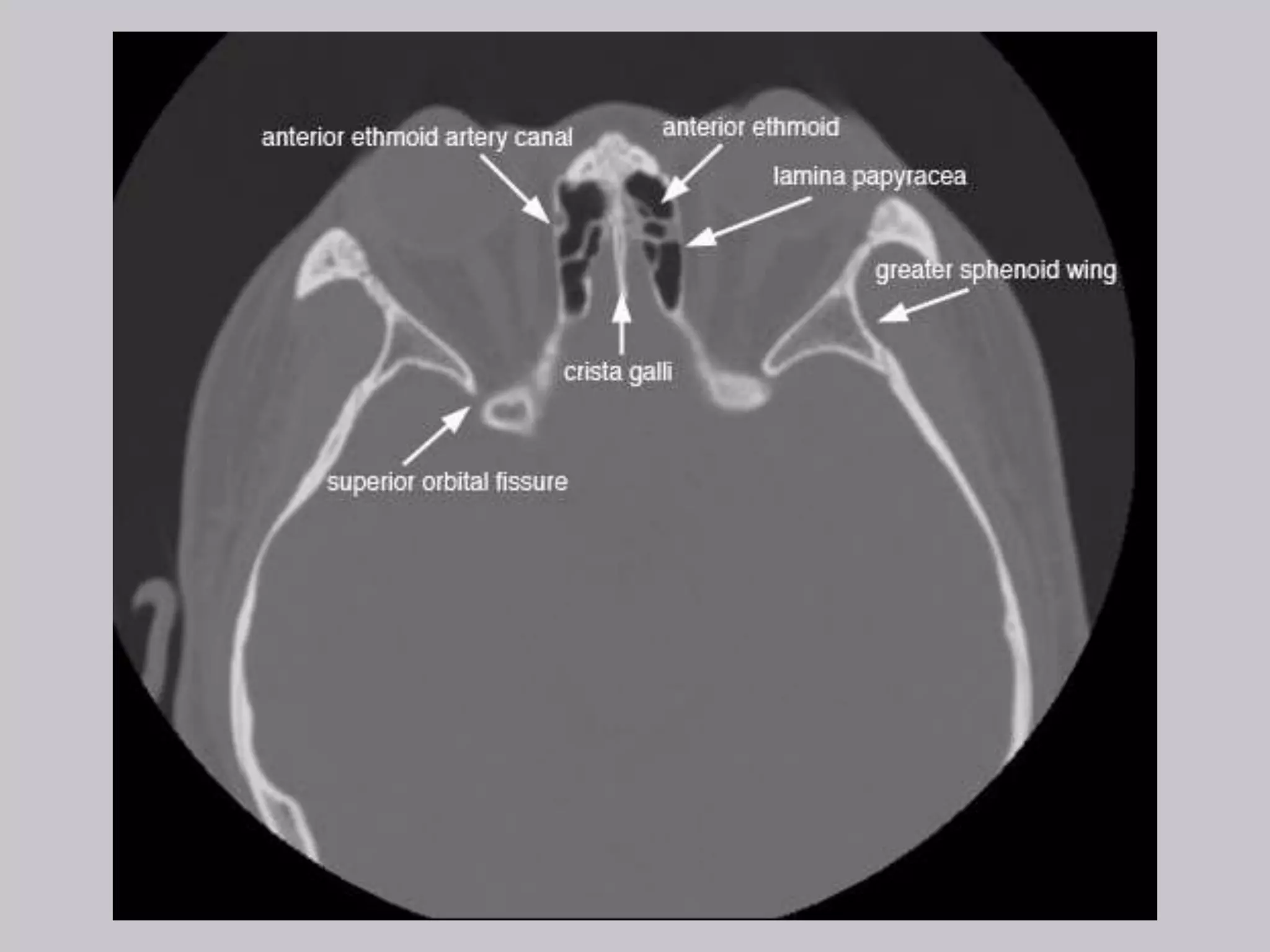 Cross Sectional Anatomy of Paranasal sinus | PPTX