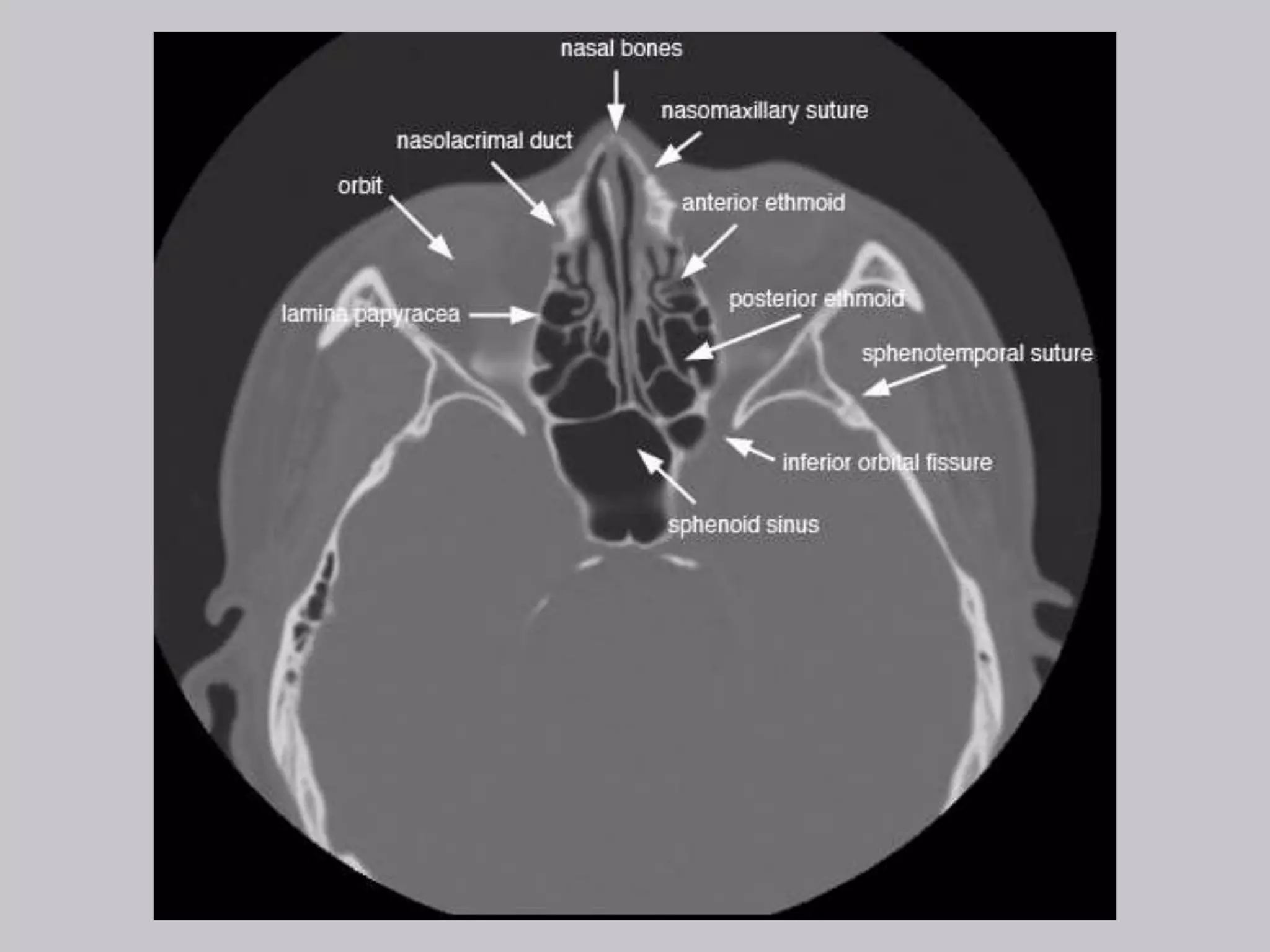 Cross Sectional Anatomy of Paranasal sinus | PPTX