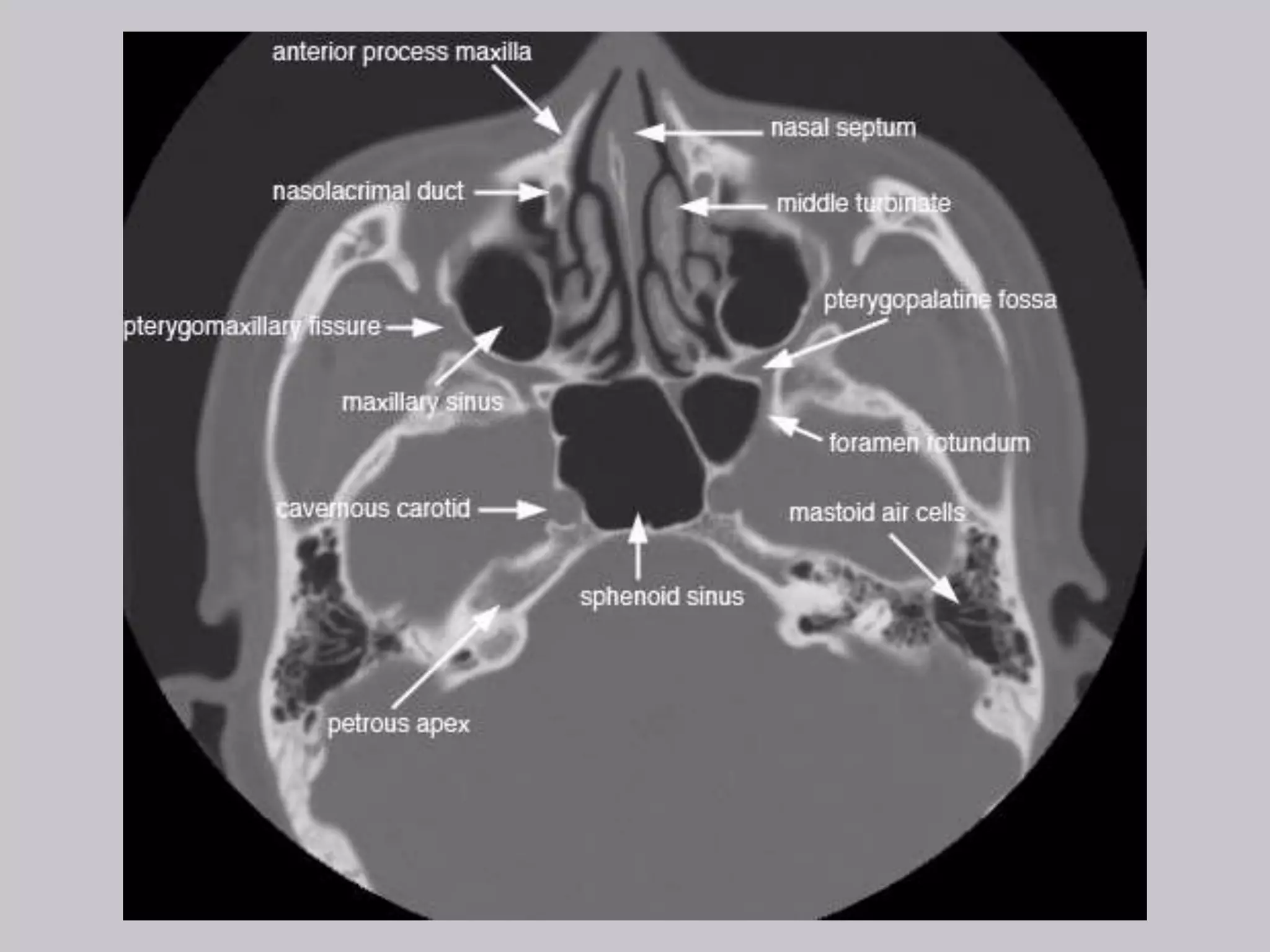 Cross Sectional Anatomy of Paranasal sinus | PPTX