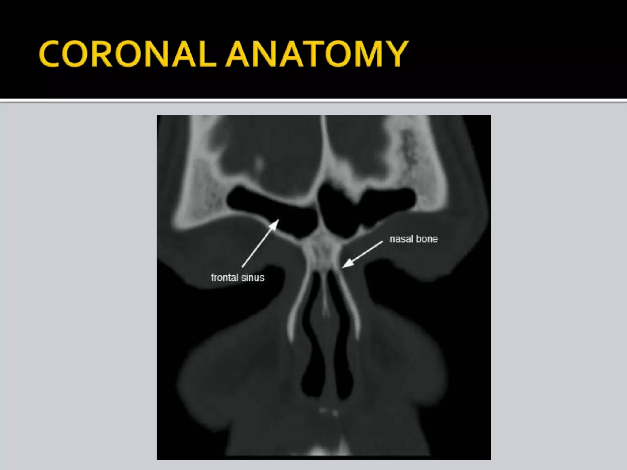 Cross Sectional Anatomy of Paranasal sinus | PPTX