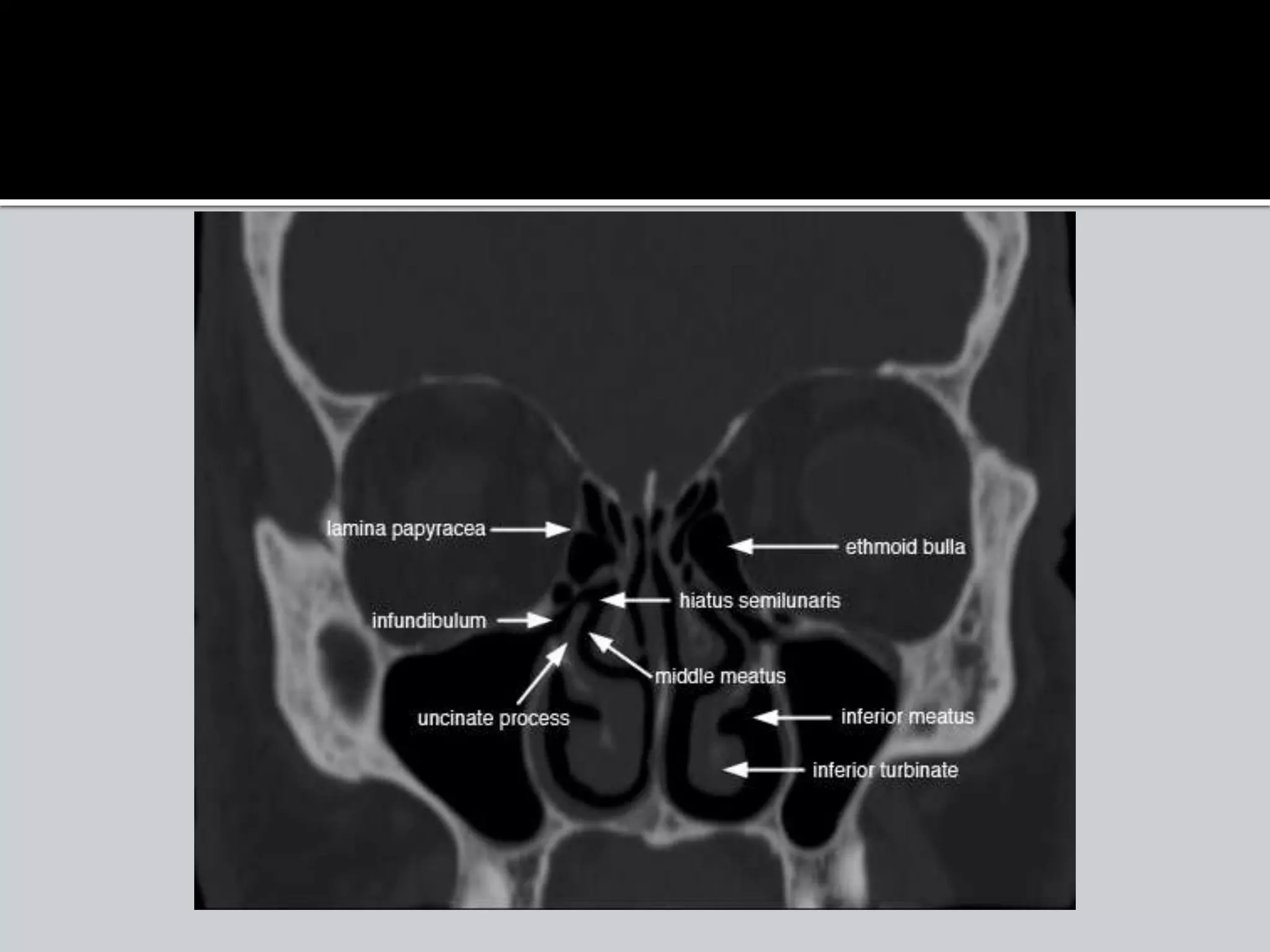Cross Sectional Anatomy of Paranasal sinus | PPTX