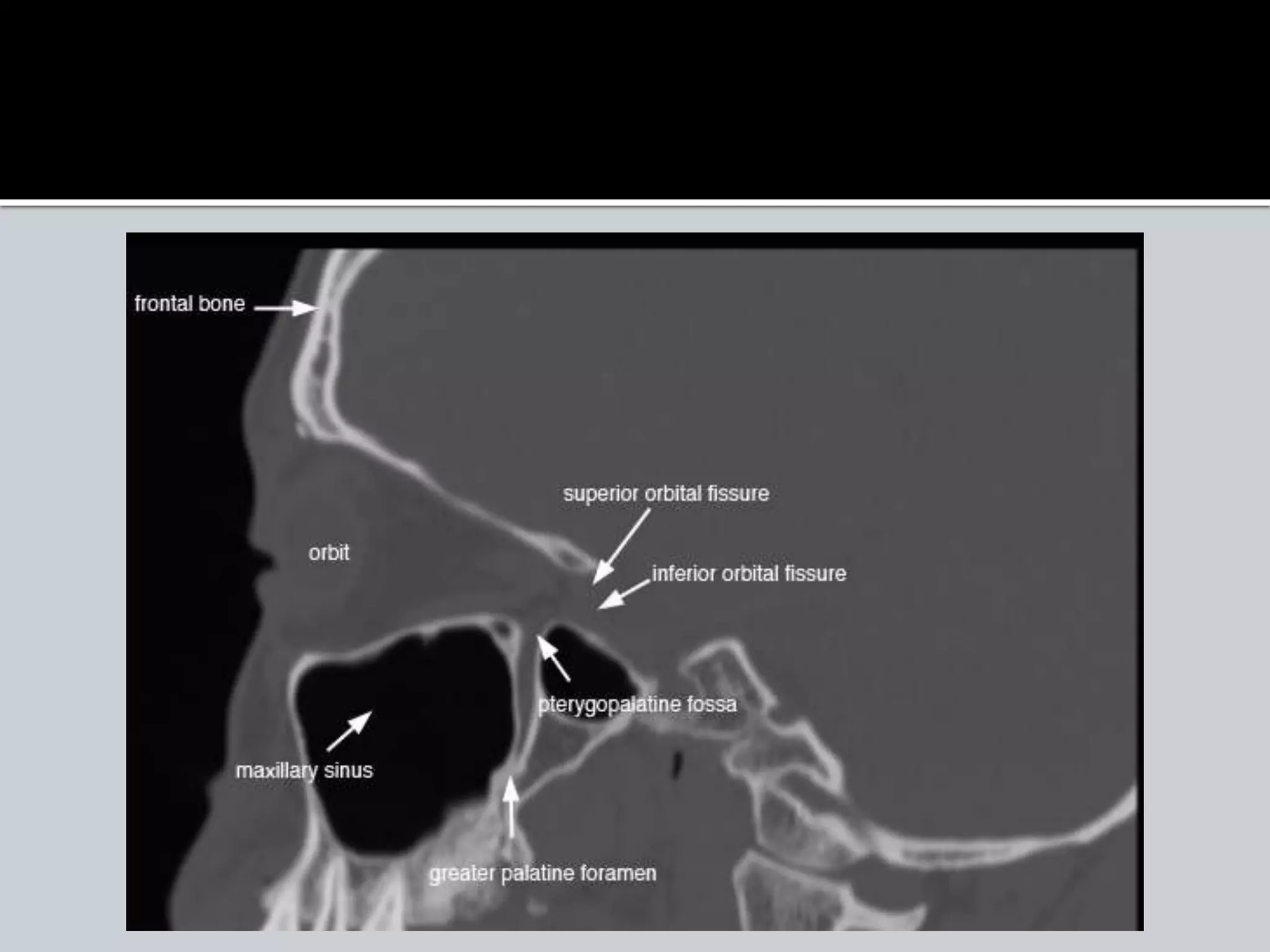 Cross Sectional Anatomy of Paranasal sinus | PPTX