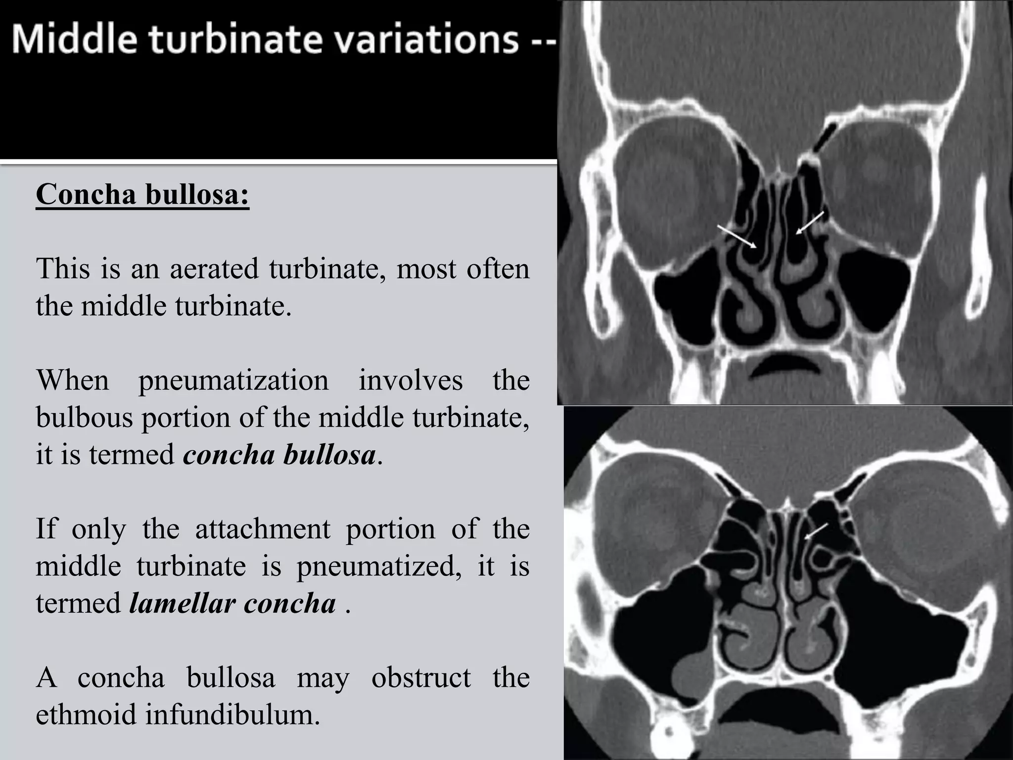 Cross Sectional Anatomy of Paranasal sinus | PPTX