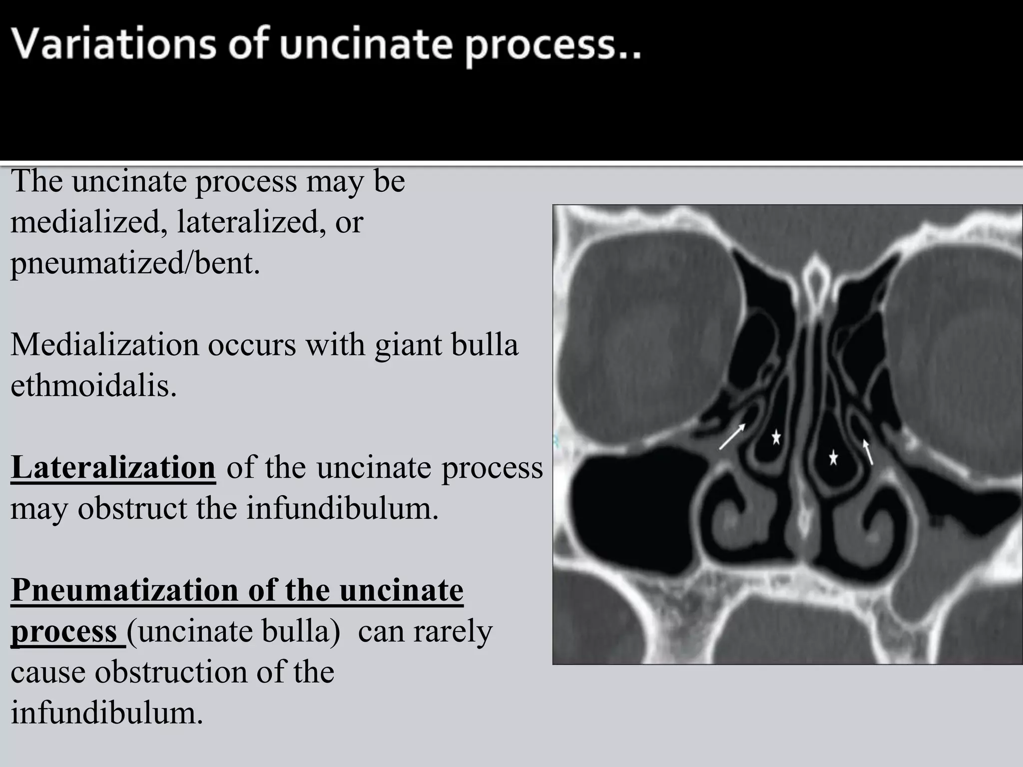 Cross Sectional Anatomy of Paranasal sinus | PPTX