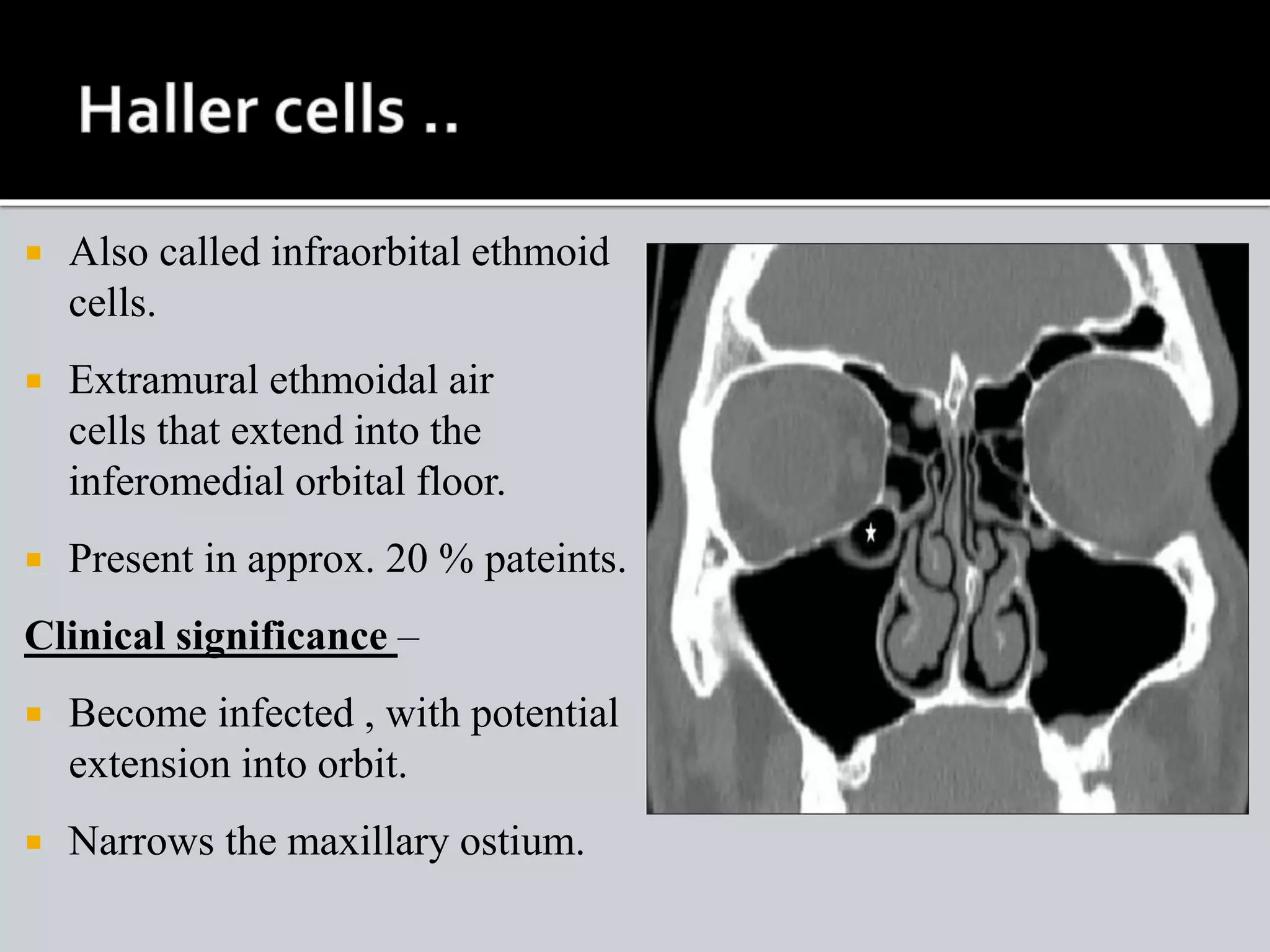 Cross Sectional Anatomy of Paranasal sinus | PPTX