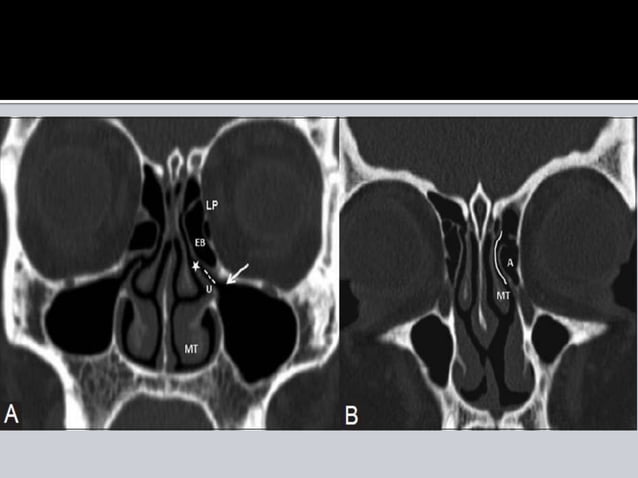 Cross Sectional Anatomy of Paranasal sinus | PPTX | Ear, Nose and ...