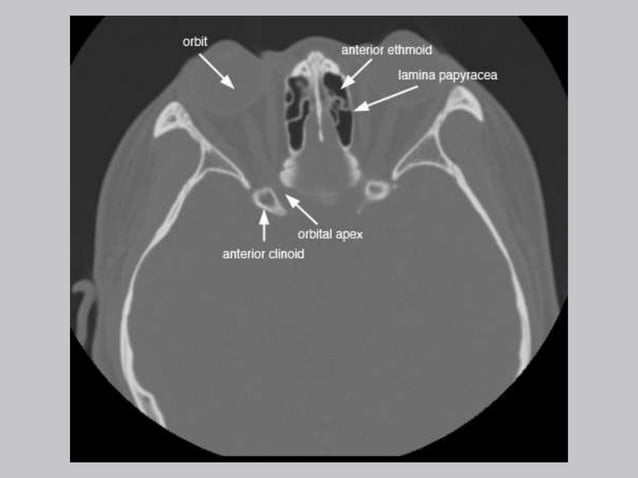 Cross Sectional Anatomy of Paranasal sinus | PPTX | Ear, Nose and ...