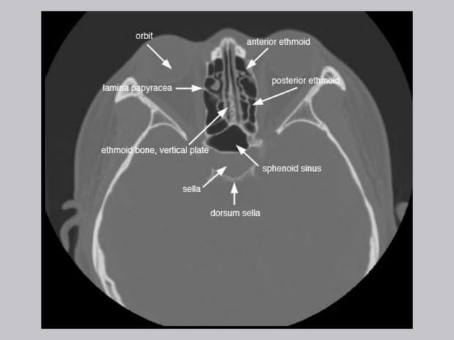 Cross Sectional Anatomy of Paranasal sinus | PPTX | Ear, Nose and ...