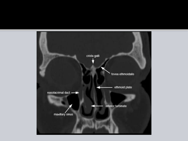 Cross Sectional Anatomy of Paranasal sinus | PPTX | Ear, Nose and ...