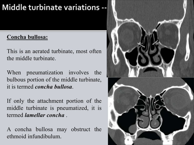 Cross Sectional Anatomy of Paranasal sinus | PPTX | Ear, Nose and ...