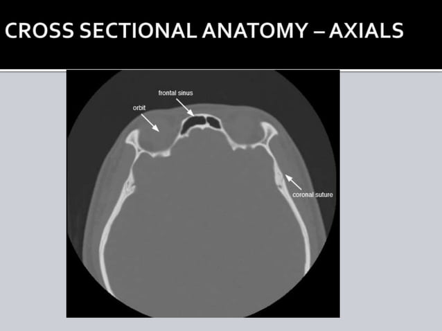 Cross Sectional Anatomy of Paranasal sinus | PPT