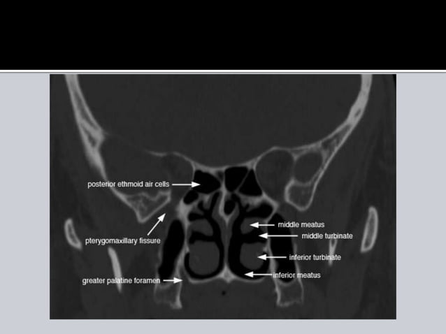 Cross Sectional Anatomy of Paranasal sinus | PPT