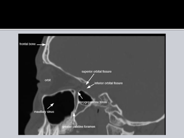 Cross Sectional Anatomy of Paranasal sinus | PPT