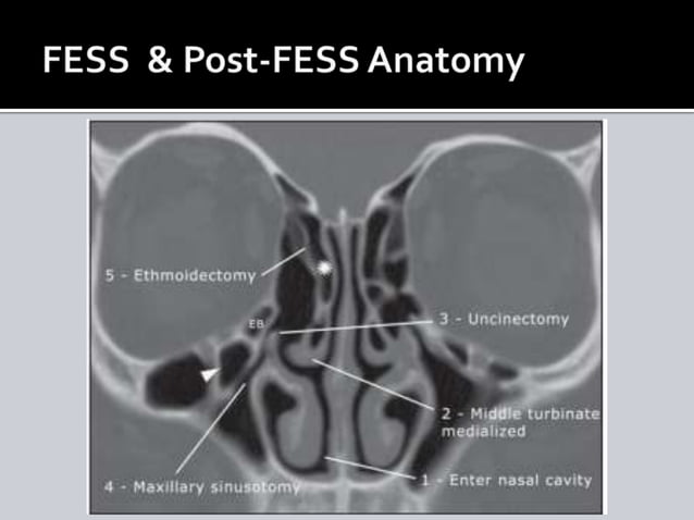 Cross Sectional Anatomy of Paranasal sinus | PPT