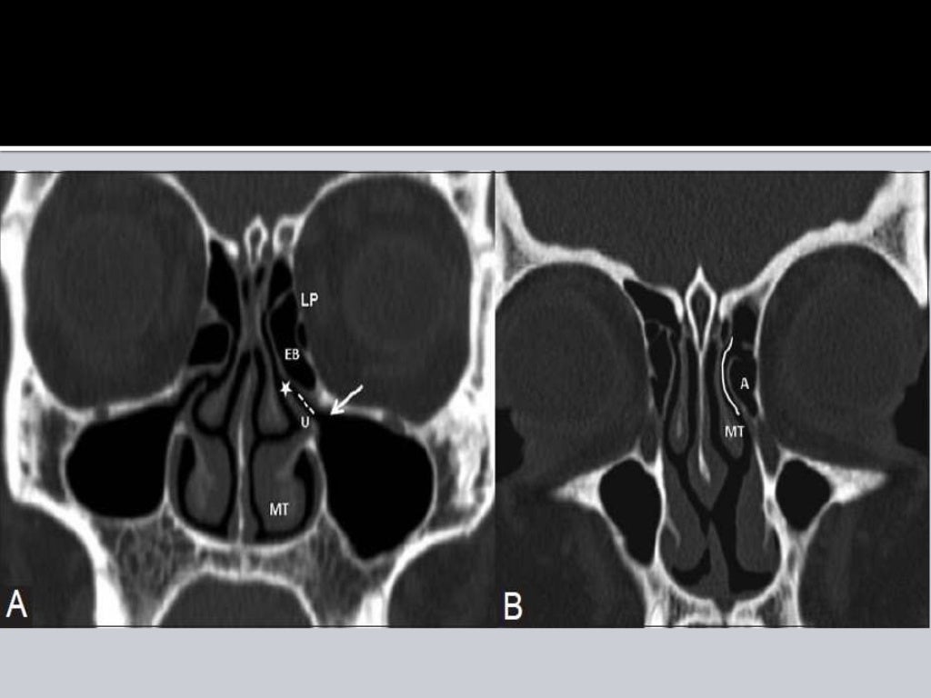 Cross Sectional Anatomy of Paranasal sinus