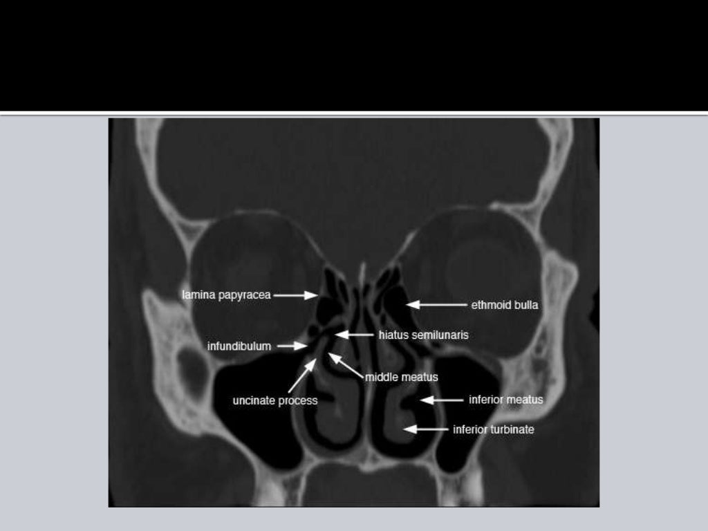 Cross Sectional Anatomy of Paranasal sinus