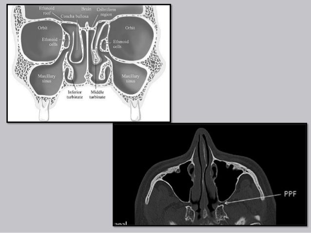 Cross Sectional Anatomy of Paranasal sinus