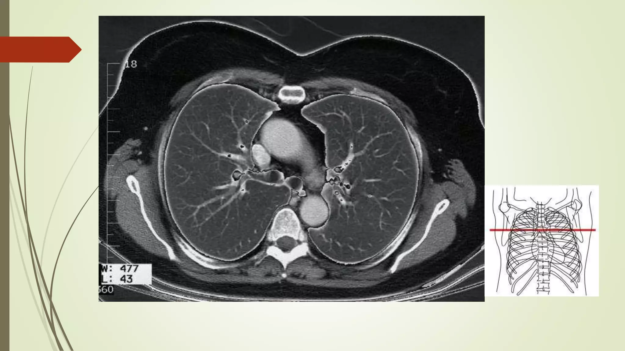 Cross section anatomy of thorax (1) | PPTX
