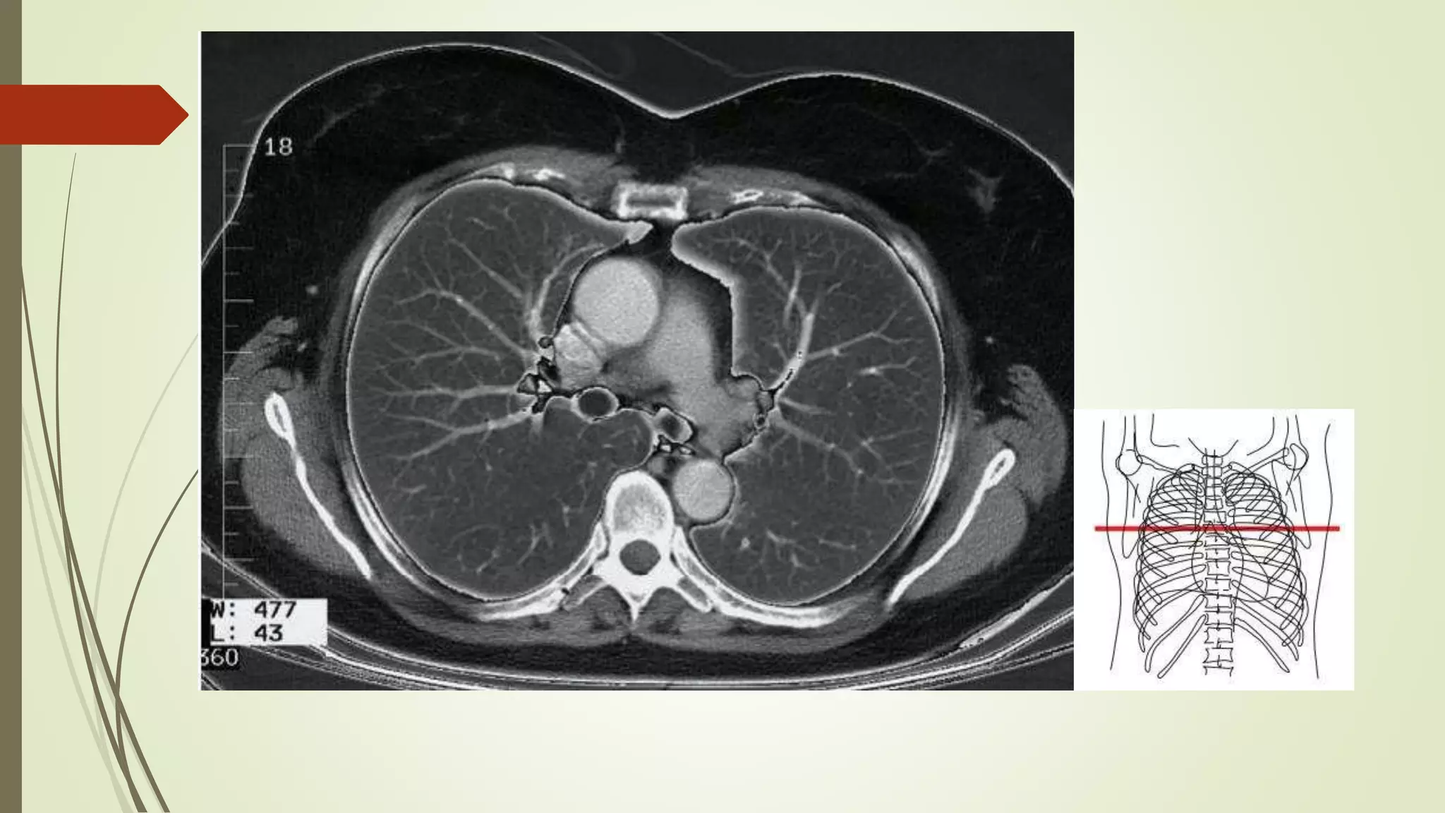 Cross section anatomy of thorax (1) | PPTX