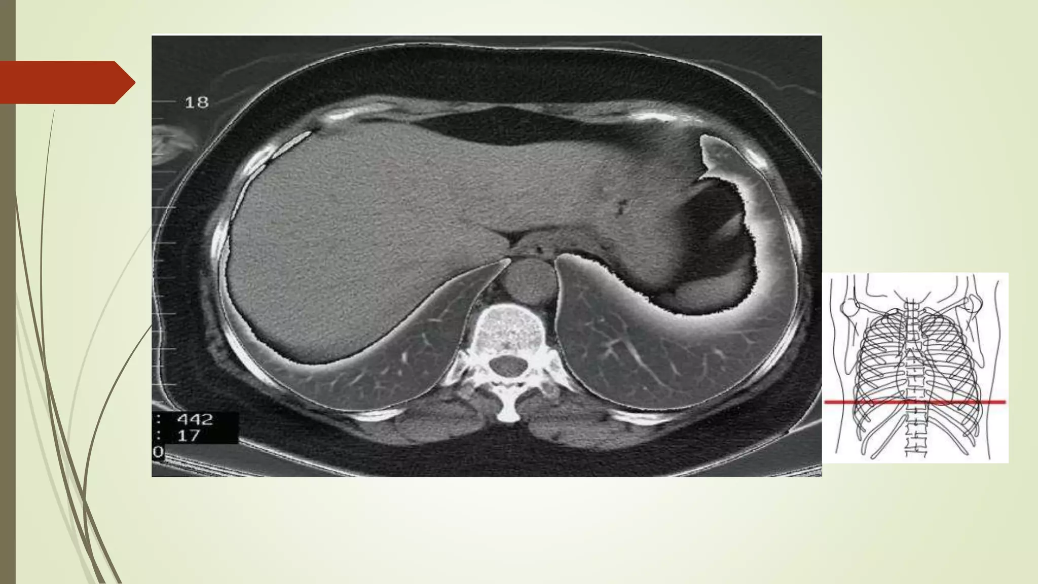 Cross section anatomy of thorax (1) | PPTX
