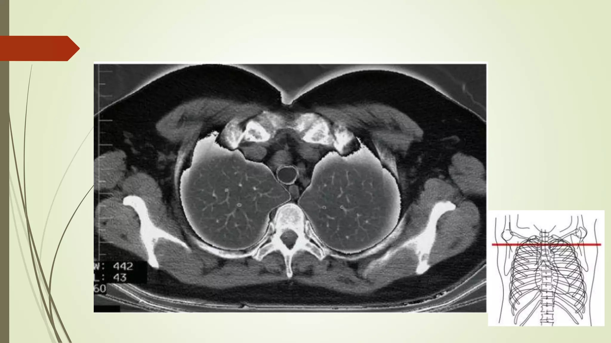 Cross section anatomy of thorax (1) | PPTX