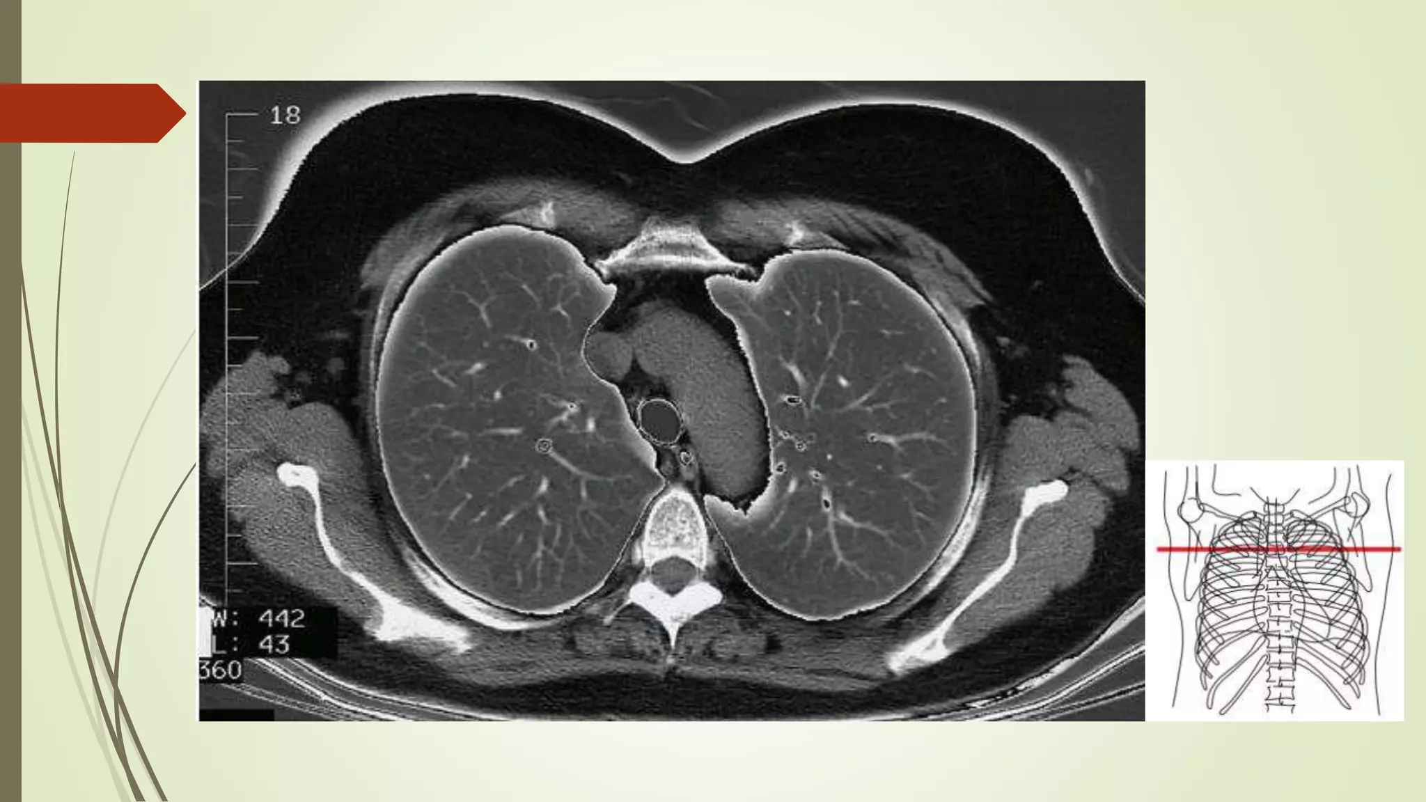 Cross section anatomy of thorax (1) | PPTX