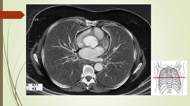 Cross section anatomy of thorax (1)