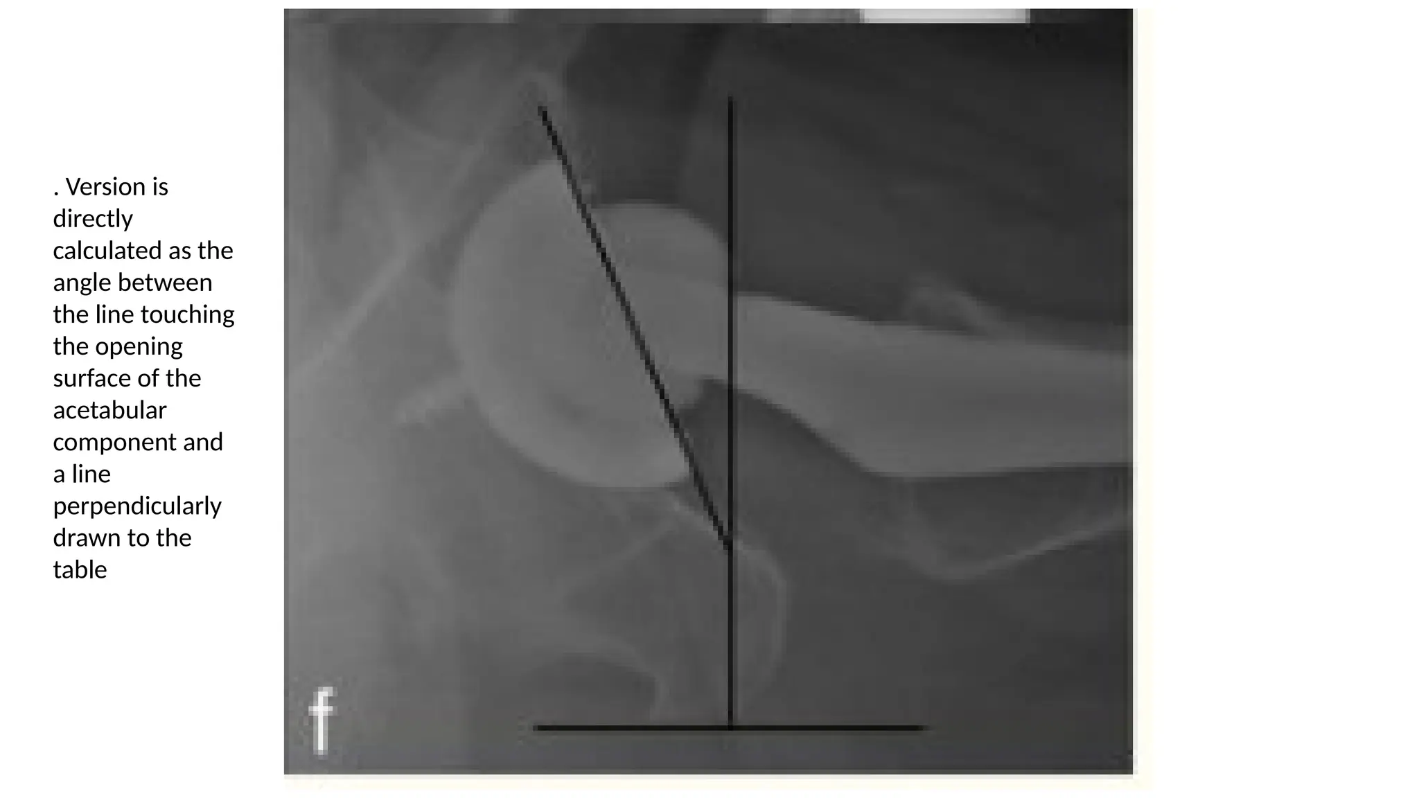 Cross_table_lateral_radiography_for_measurement_of_acetabular (2).pptx