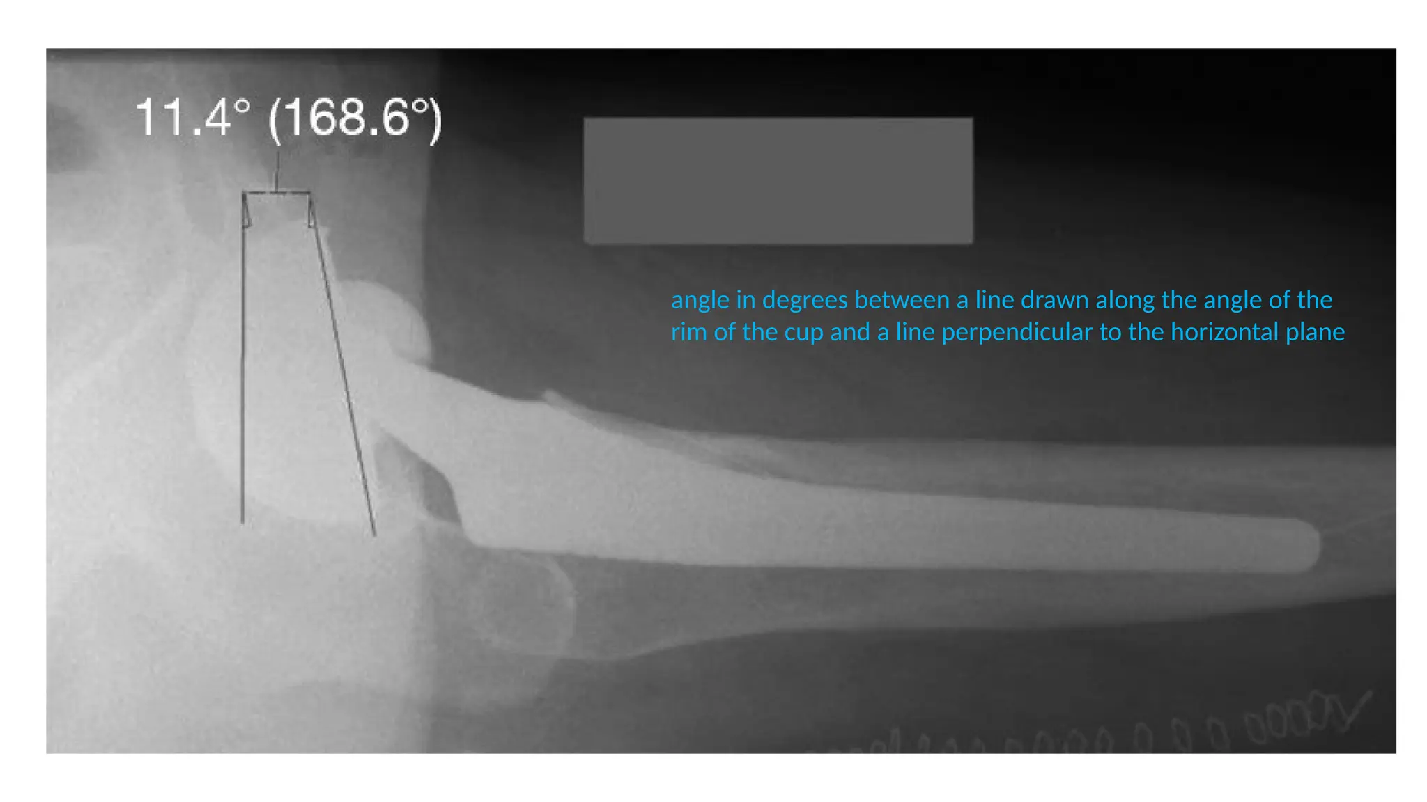 Cross_table_lateral_radiography_for_measurement_of_acetabular (2).pptx