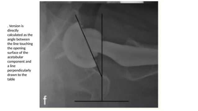 Cross_table_lateral_radiography_for_measurement_of_acetabular (2).pptx