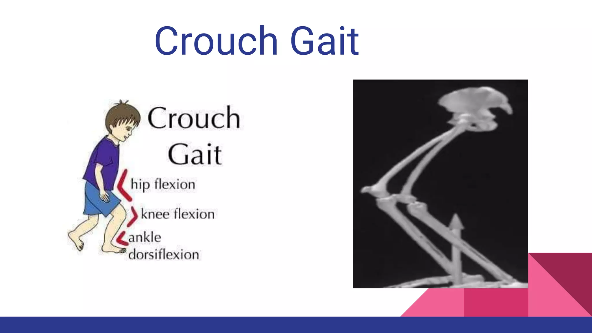 Crouch gait and its brief Medical And Physiotherapy Management | PPTX