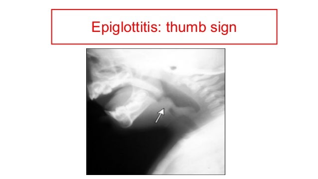 Thumbprint Sign Epiglottitis