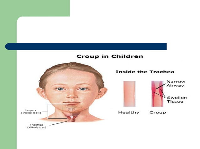 Croup syndrome | PPT | Lung and Respiratory Health | Diseases and ...