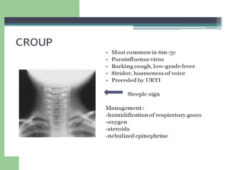 Croup syndrome | PPT