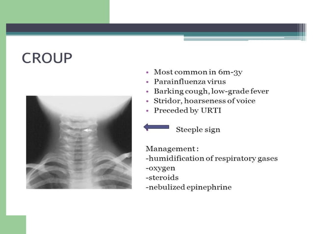 Croup syndrome | PPT | Lung and Respiratory Health | Diseases and ...