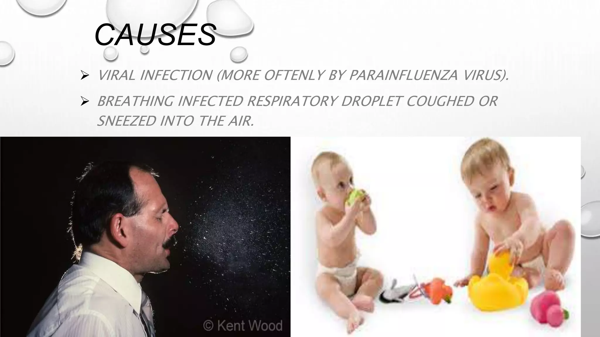 Croup disease | PPTX