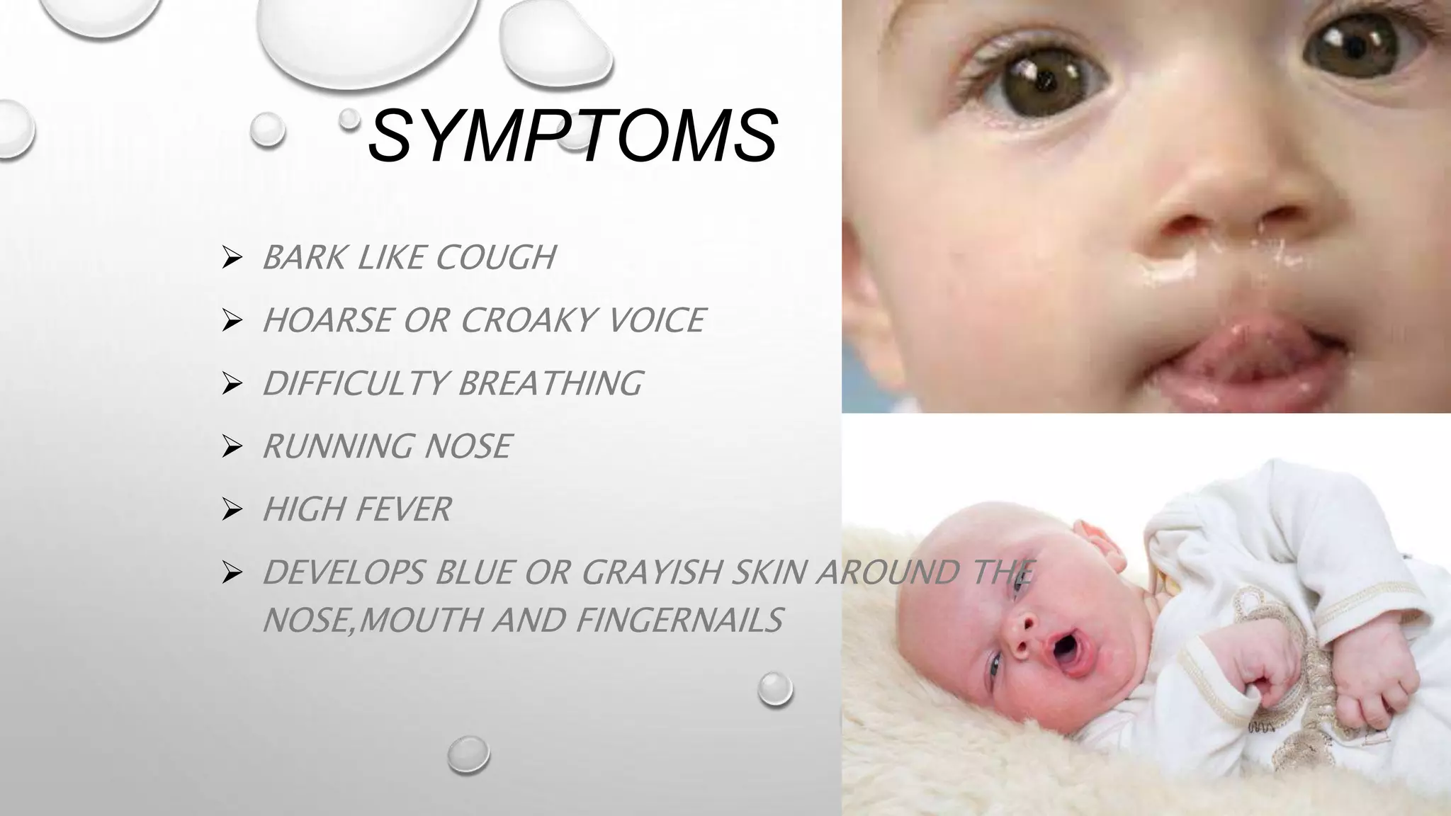 Croup disease | PPTX