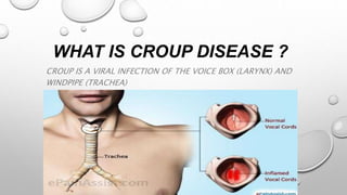 Croup disease | PPTX