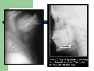 A comprehensive description on Croup & Epiglotitis | PPTX