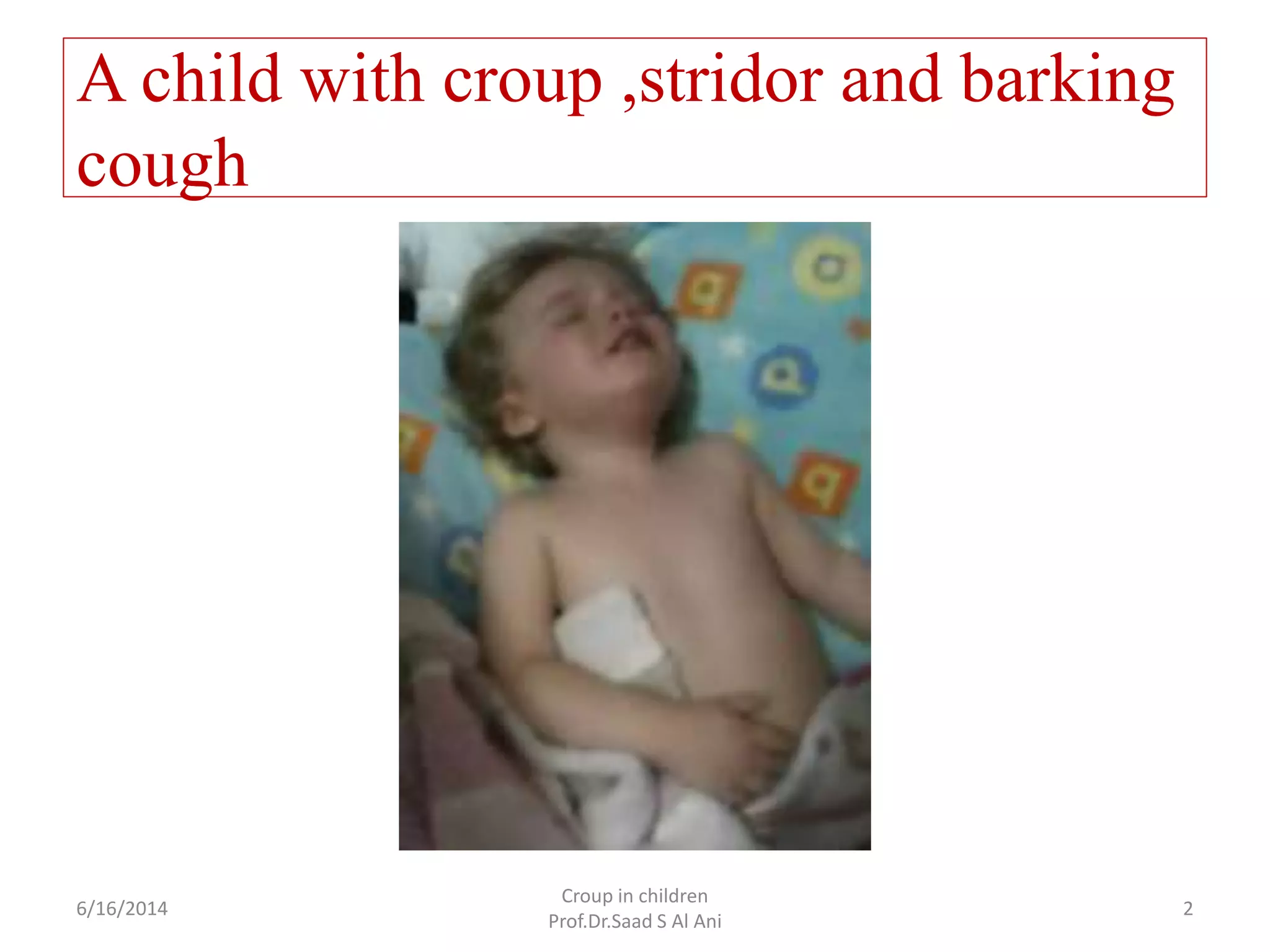 Croup in children | PPTX