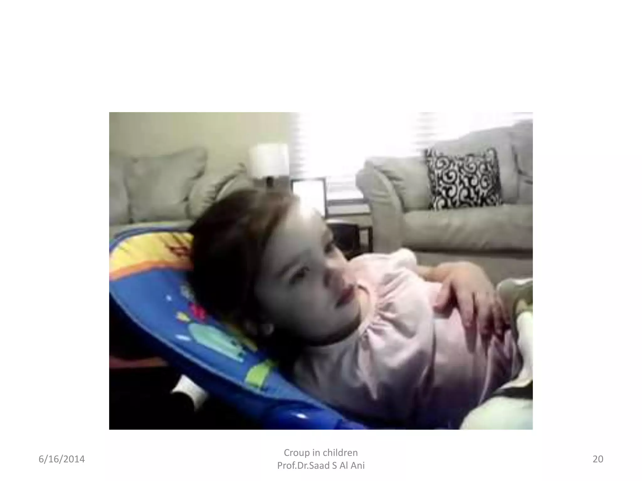 Croup in children | PPTX