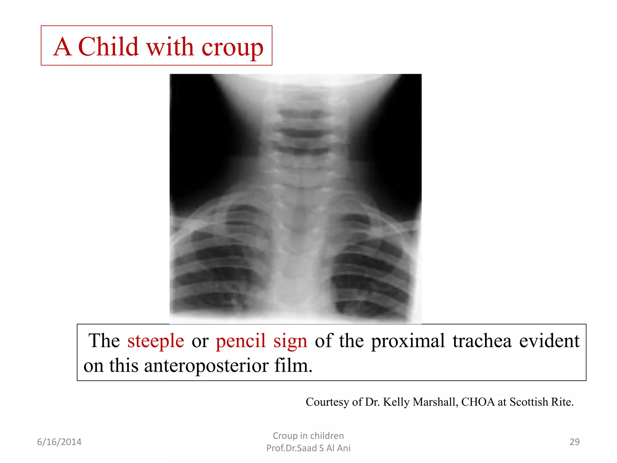 Croup in children | PPTX