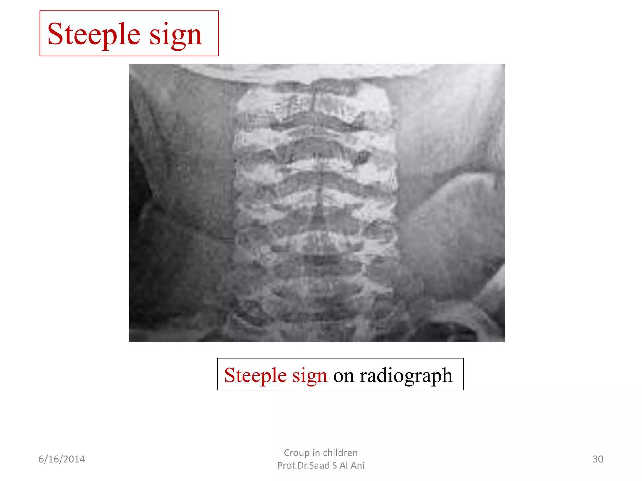 Croup in children | PPTX