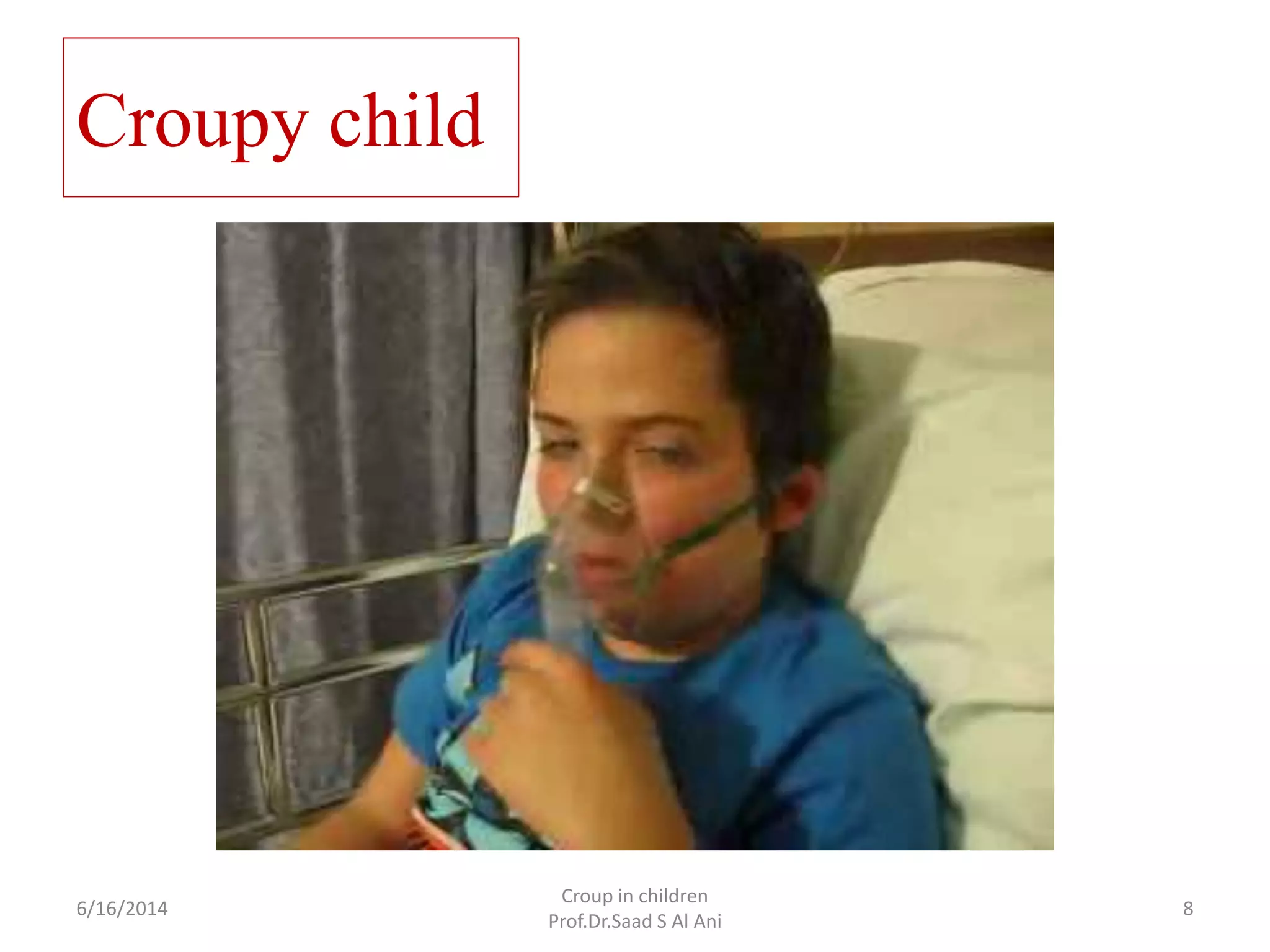 Croup in children | PPTX