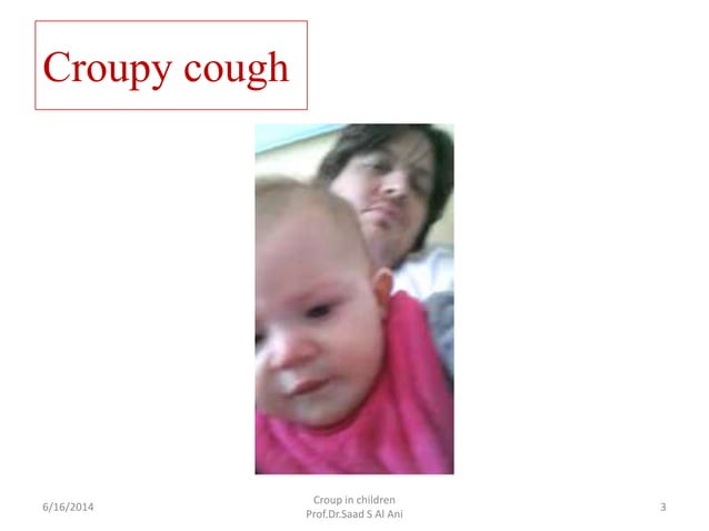 Croup in children | PPTX