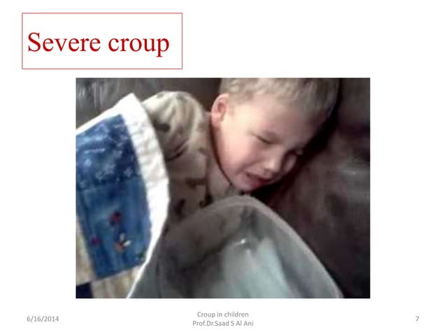 Croup in children | PPTX