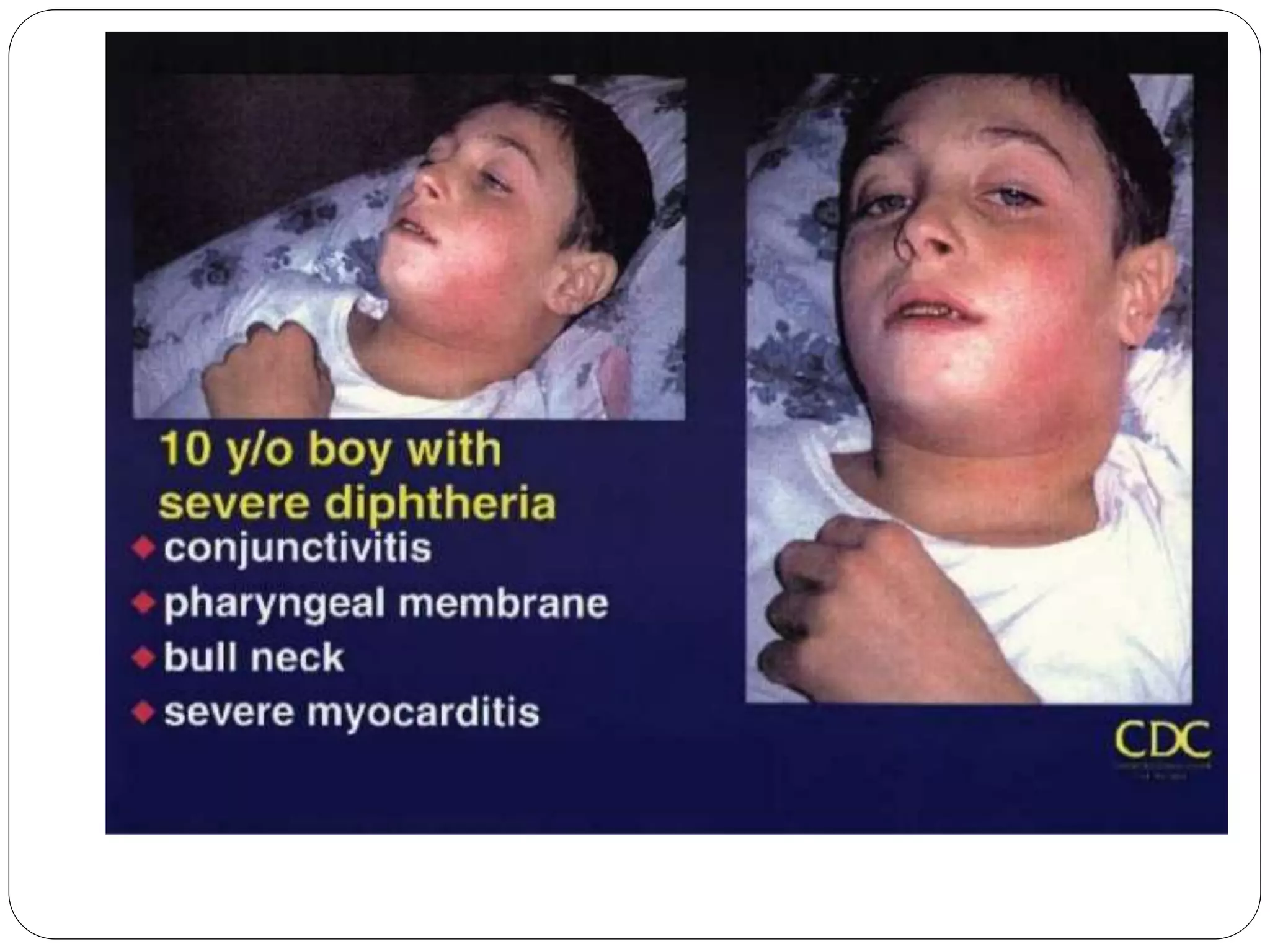 Croup syndrome( diptheria,acute epiglottitis,aryngotracheobronchitis ...
