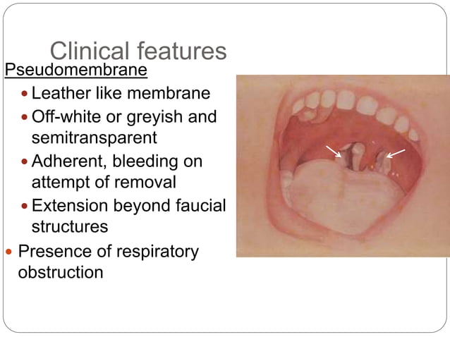 Croup syndrome( diptheria,acute epiglottitis,aryngotracheobronchitis ...